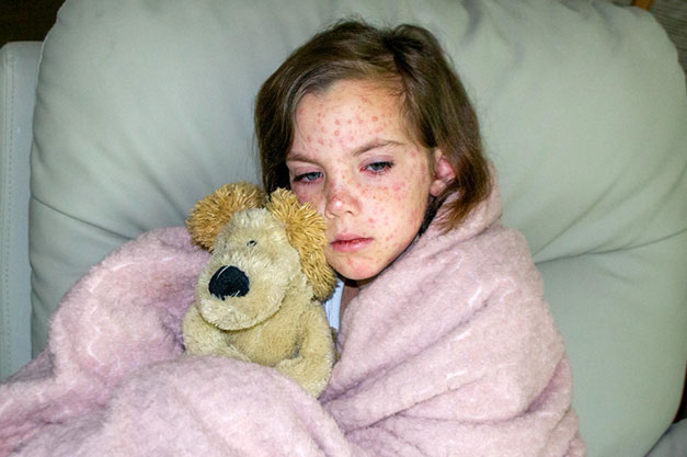 Ako dlho trvajú kiahne a koľko dní je dieťa s kiahňami infekčné ...