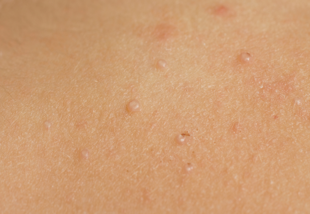 Molusky a 3-mesačná homeopatická liečba | etabletka