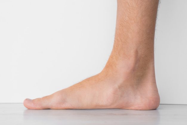 Ploché nohy – čo ich spôsobuje a čo pomôže od bolesti? | etabletka